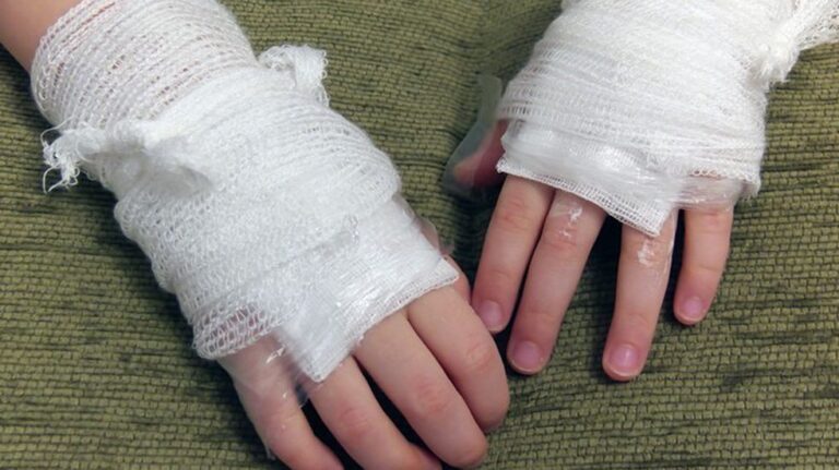 Qué Hacer Ante Las Quemaduras Por Pirotécnicos En Niños Mudo Social